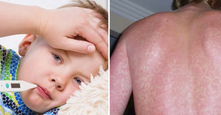 Todo lo que debes saber para prevenir la fiebre escarlatina