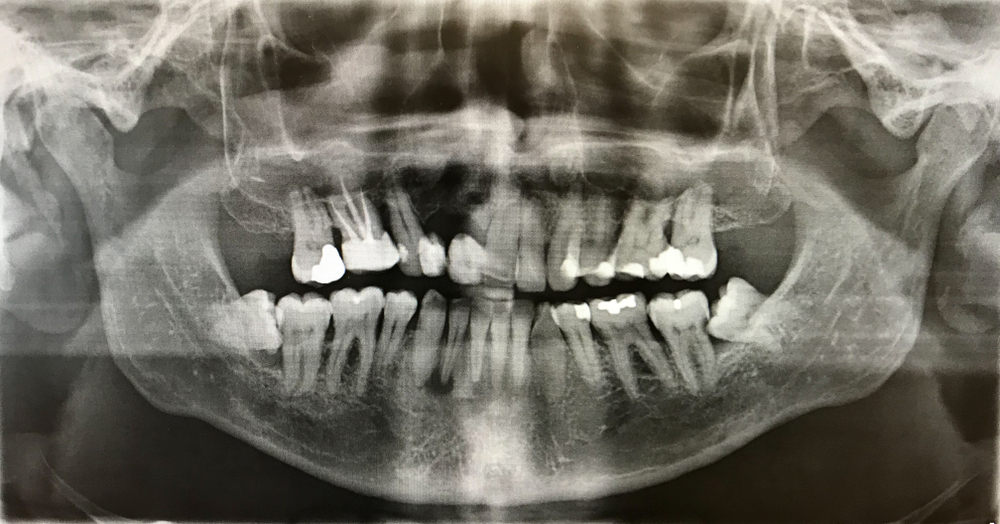 Radiografia De Los Dientes